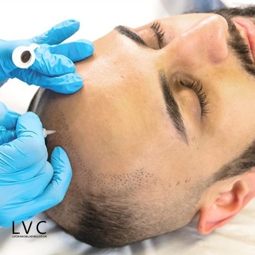 SM1 - Scalp Micropigmentation Training Course - LVC Microblading